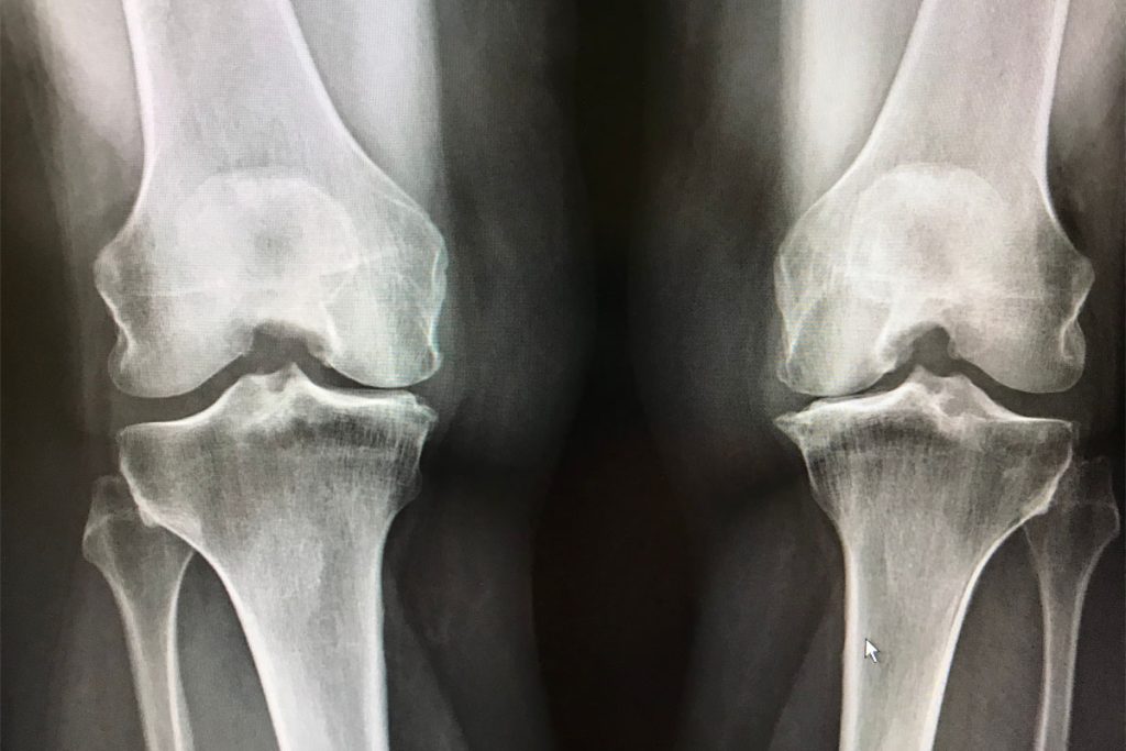 Knee Problems - Mobility Center